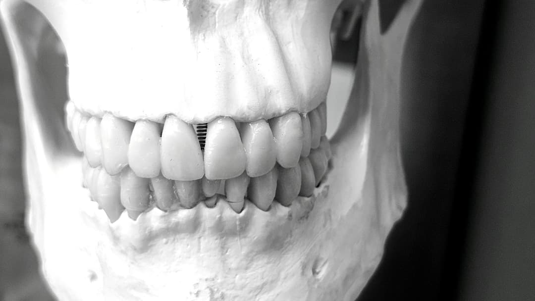 Back Molar Tooth Extraction: What to Expect and How to Prepare ...