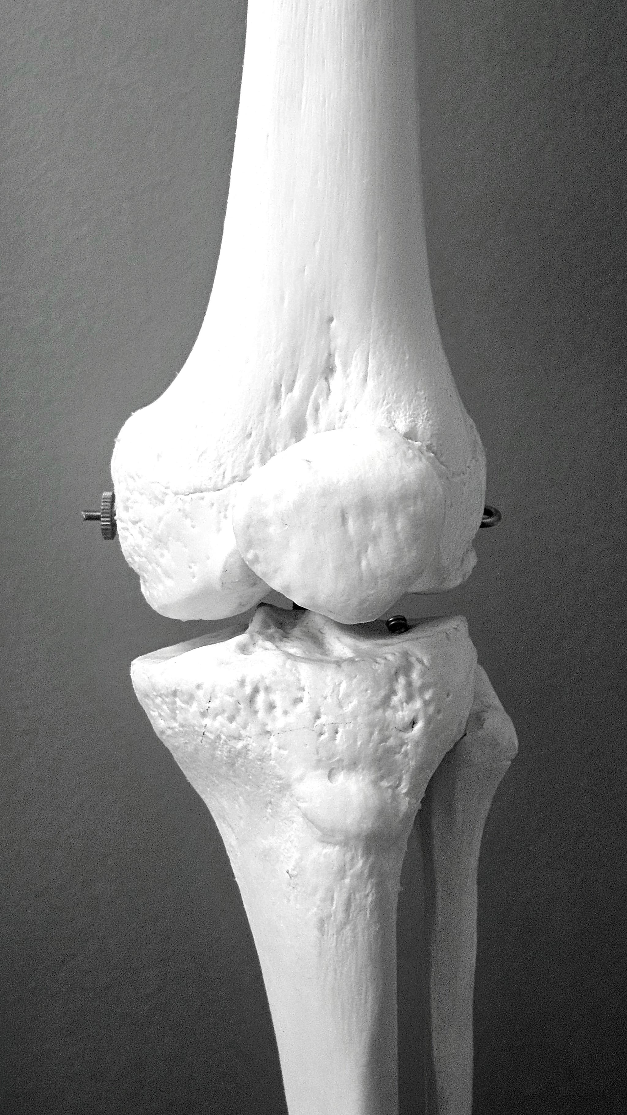 MPFL Reconstruction with Tibial Tubercle Osteotomy: A Comprehensive ...