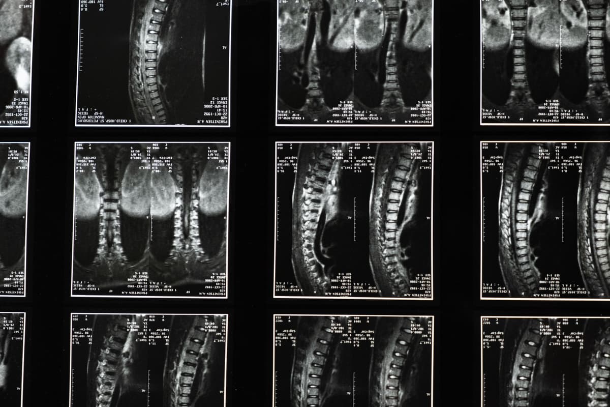 Can Neck Pain Cause Sciatica? Exploring the Surprising Connection ...