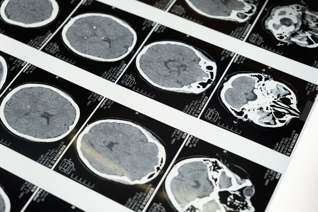 Chemo Brain vs Dementia: Understanding the Differences and Connections ...