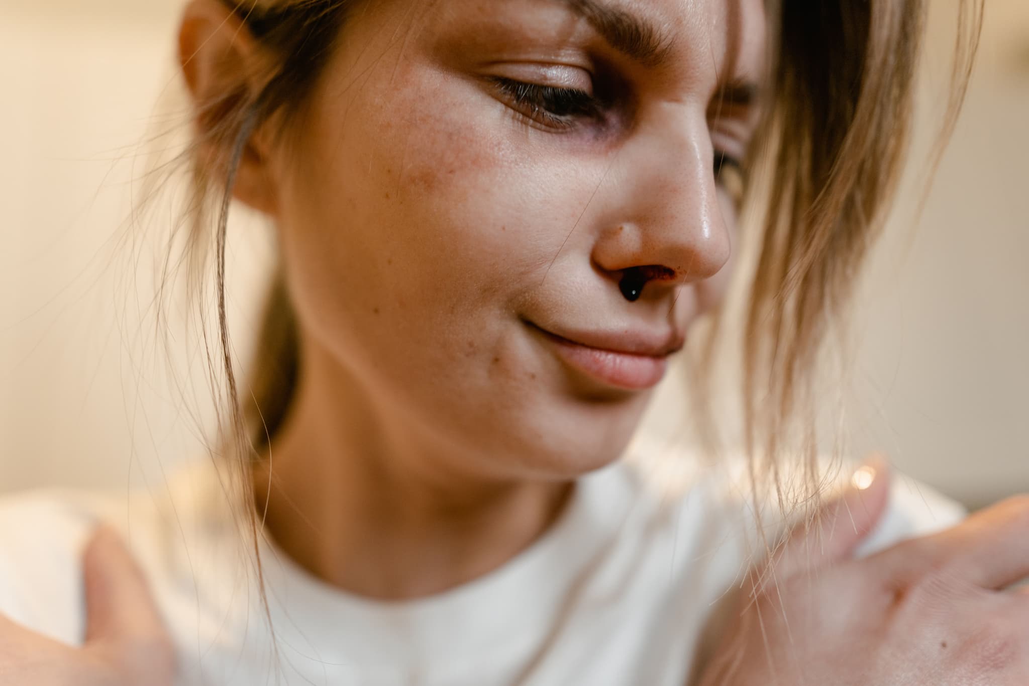 Understanding Rhinophyma: Early Stages and Detection | Harmony Wellness ...
